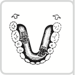 Skeletal Sector Expansion Screws - Orthodontic Supplies Australia