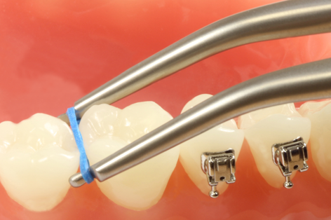 Ixion Force Module Separator - Orthodontic Supplies Australia